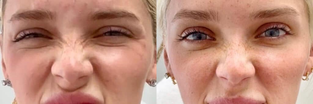 Before After Photos Tampa Archives - Anthony Aesthetics